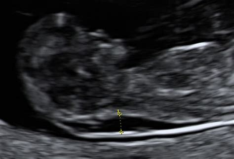 Noninvasive Prenatal Fetal Screening Tests Gynecology And Obstetrics