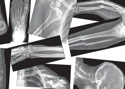 Broken Bones Xrays