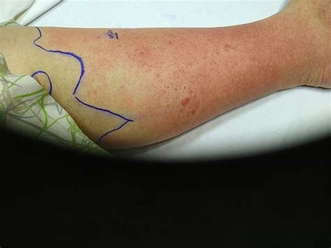 What Is Cellulitis A Dermatologist Explains