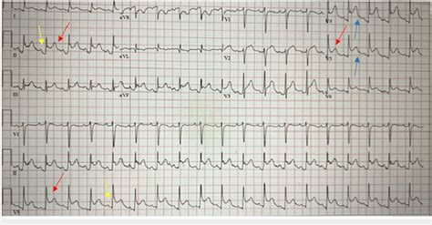 Electrocardiogram On Initial Presentation The Image Shows Diffuse St Download Scientific