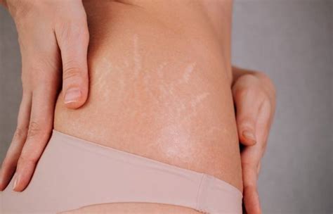 Morpheus8s Innovative Stretch Mark Removal Solutions