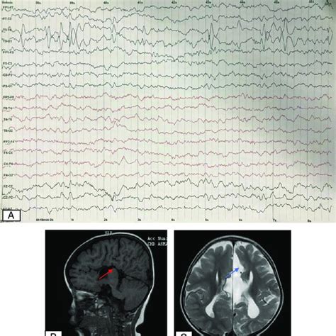 A Electroencephalography Showed Generalized Epileptiform Discharge On Download Scientific