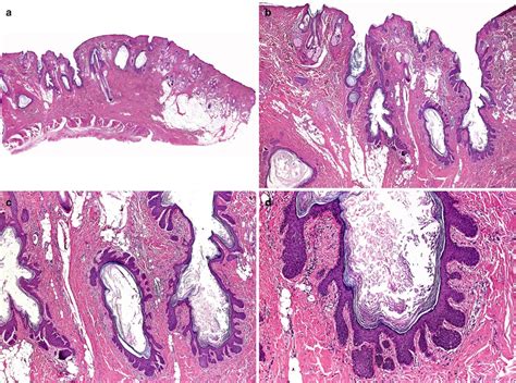 Nevus Comedonicus Springerlink