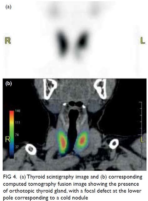 Ectopic Thyroid
