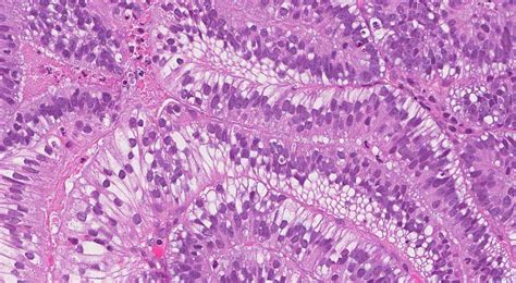 Endometrioid Carcinoma Of The Uterus Ottawa Atlas Of Pathology
