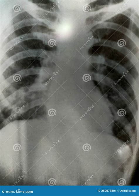 Chest X Rays Show Advanced Pulmonary Tuberculosis Royalty Free Stock