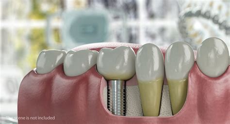 치아 임플란트 컬렉션 3d 모델 109 3ds C4d Fbx Ma Obj Max Free3d