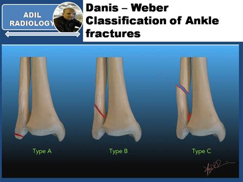 Denis Weber Classification Of Ankle Radiology Classroom Facebook