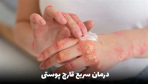 دشمن قارچ پوستی برای قارچ پوستی چی خوبه؟