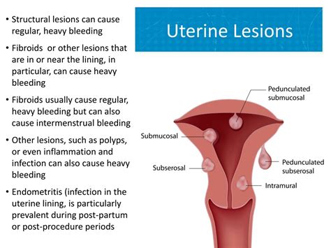 Ppt Abnormal Vaginal Bleeding Causes And Evaluation Powerpoint Presentation Id