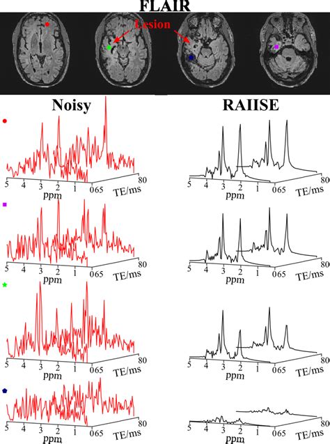 1 H Mrsi Results From A Pte Patient The Top Panel Shows The Anatomical Download Scientific