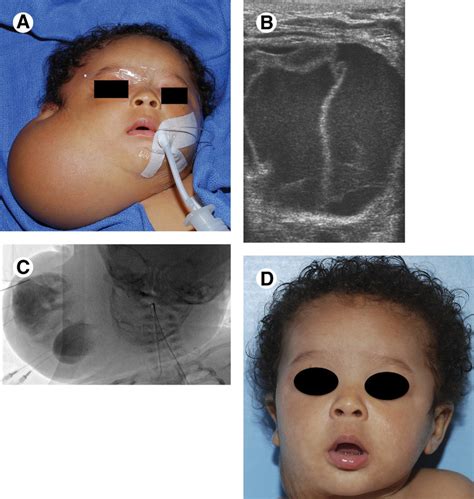 A Large Lymphatic Malformation Of The Right Side Of The Neck Of The Download Scientific