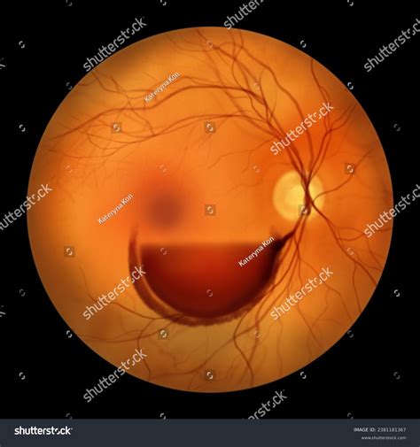 Retinal Hemorrhage