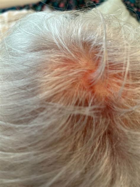 Husband Has Weird Bleeding On His Scalp Post Hip Replacement R