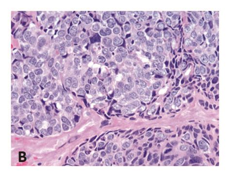 Histopathology Of The Resected Bladder Lesion A Low Power Field Hande