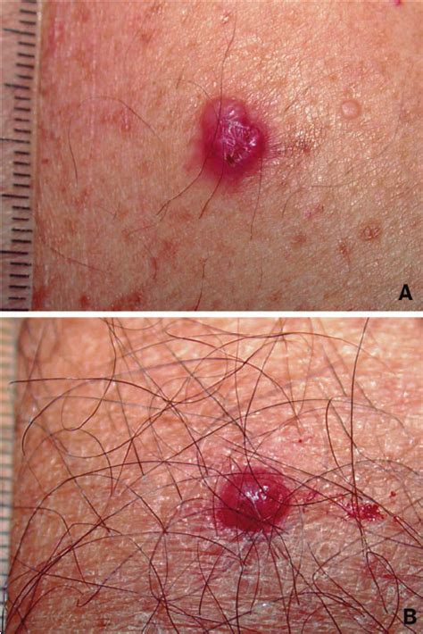 Nodular Skin Lesions