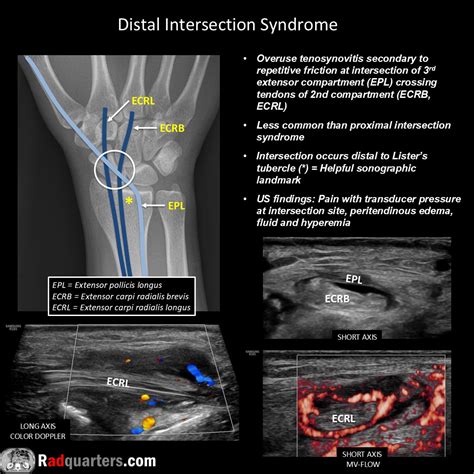 Radquarters Dacrocystitis On Ct Inflammation Of Lacrimal Gland Rim