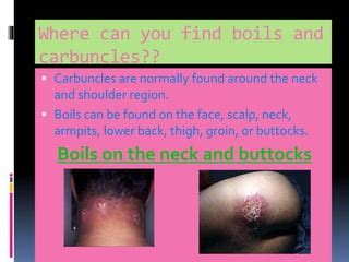 Boils On Lower Back