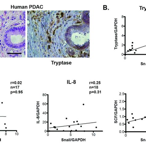 Snail Expression In Human Pdac Tumors Correlates With Mast Cell
