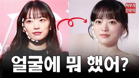 땅콩형얼굴 탈출기 볼꺼짐 볼패임 이렇게 쉽게 얼굴형 예뻐지는 법 필러 쥬베룩 실리프팅 인모드 슈링크