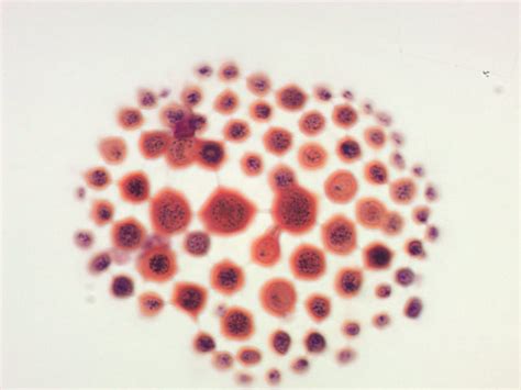 Cryptococcus Neoformans Gram Stain