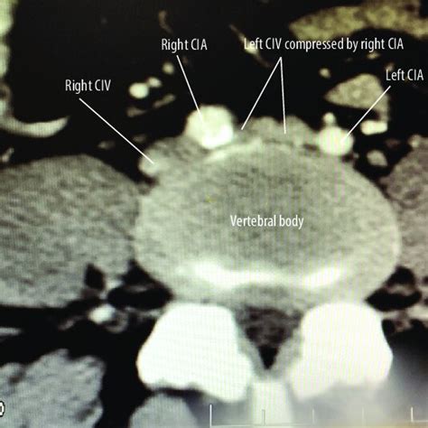 A Ct Scan Showing Thrombus In Left Common Iliac Vein Civ Download