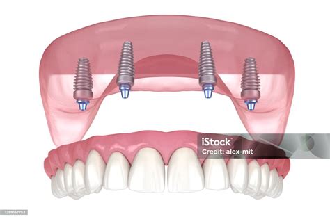 임플란트에 의해 지원되는 4 시스템에 잇몸 모두와 상악 보철 인간의 치아와 의치의 의학적으로 정확한 3d 그림 Edentulous에 대한 스톡 사진 및 기타 이미지 Istock