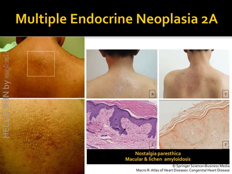 Skin Signs In Pheochromocytoma Hello Skin By หมอผิวหนัง