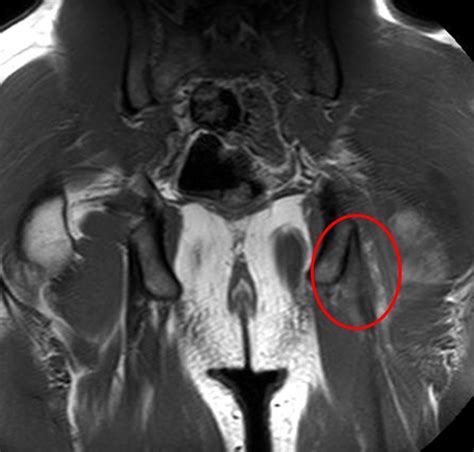 Pulled Hamstring Mri