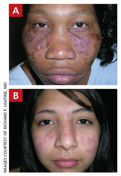 Discoid Lupus Erythematosus Scalp Case Report Contagious Rash In