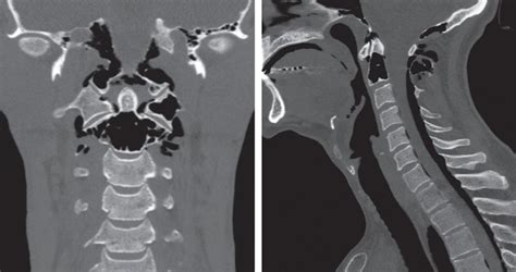 Idiopathische Kraniozervikale Hyperpneumatisation Mit Pneumorrhachis