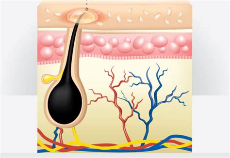 Ingrown Hair Diagram