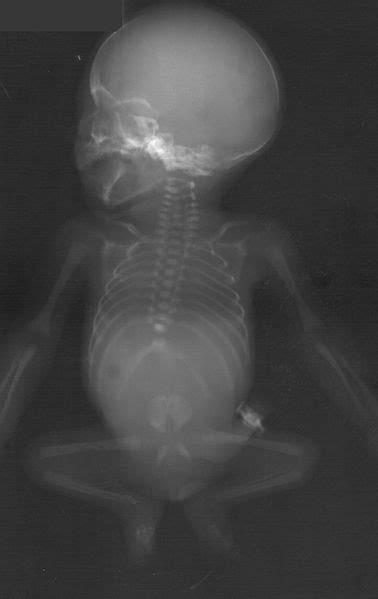 Caudal Regression Syndrome Buyxraysonline