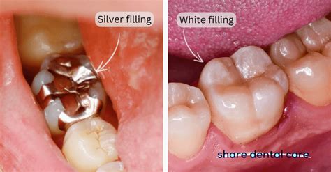 Silver Fillings Vs White Fillings Which Is Better For Your Teeth Share Dental Care