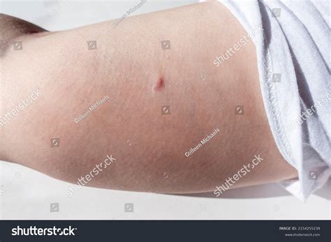 25 Iud Removal Images Stock Photos Vectors Shutterstock