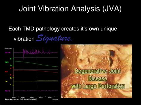 Ppt Joint Vibration Analysis Jva Powerpoint Presentation Free