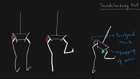 Trendelenburg Test Youtube