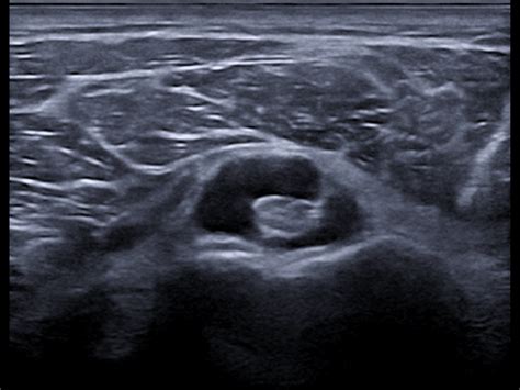 Long Head Of The Biceps Tenosynovitis Ultrasound Cases