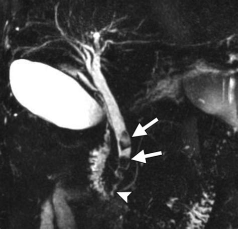 Distal Cbd Stricture And Choledocholithiasis In An 80 Year Old Man Mip
