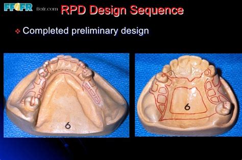 7 Designing Rpds Planning Sequence For Rpd Patients