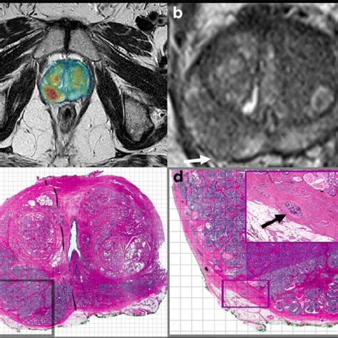 Pdf Routine Pelvic Mri Using Phased Array Coil For Detection Of Extraprostatic Tumour