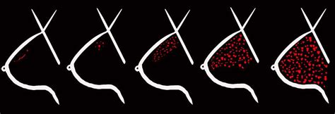 Mammography Calcifications Radiology Ucla Health