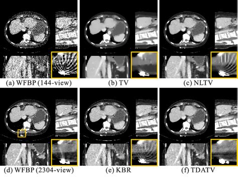 Figure From Helical CT Reconstruction From Sparse View Data Through Exploiting The D
