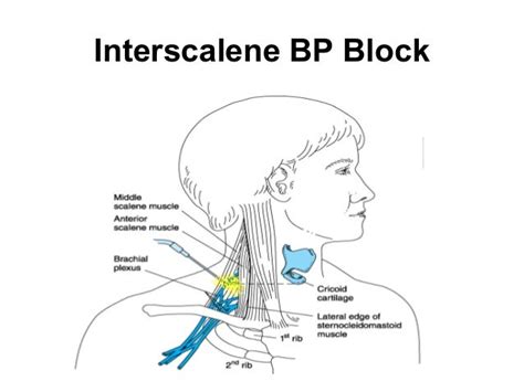 Brachial Plexus Block