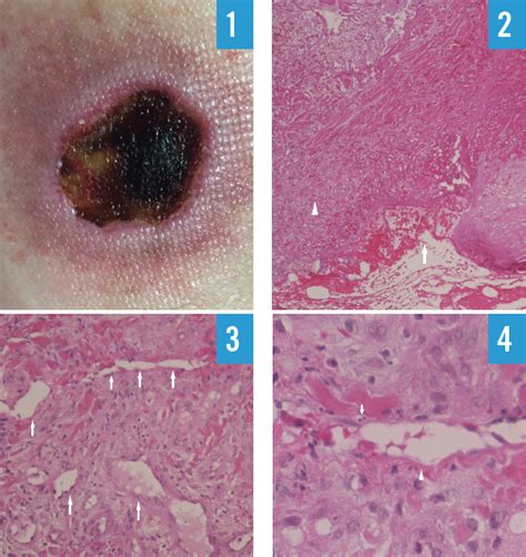 Ectima Gangrenoso Pseudomonas Pseudomonas Skin Infections