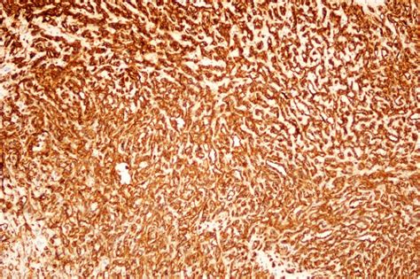 病例分享肝血管肉瘤1例 资讯频道 华夏病理网 病例分享肝血管肉瘤1例 资讯频道 华夏病理网