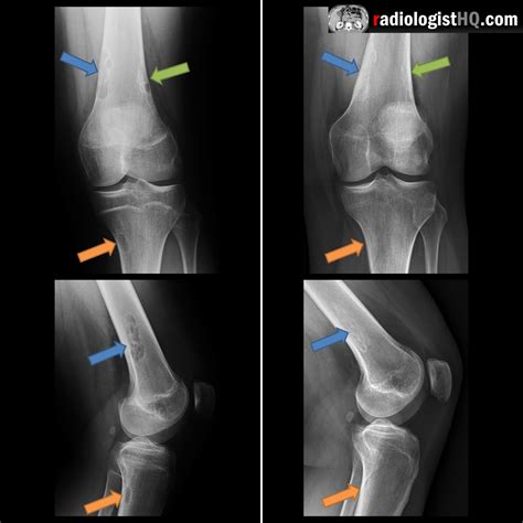 Ossifying Fibroma Radiology