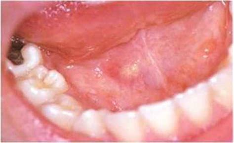Flashcards Table On Oral Med Cysts Of The Oral Region