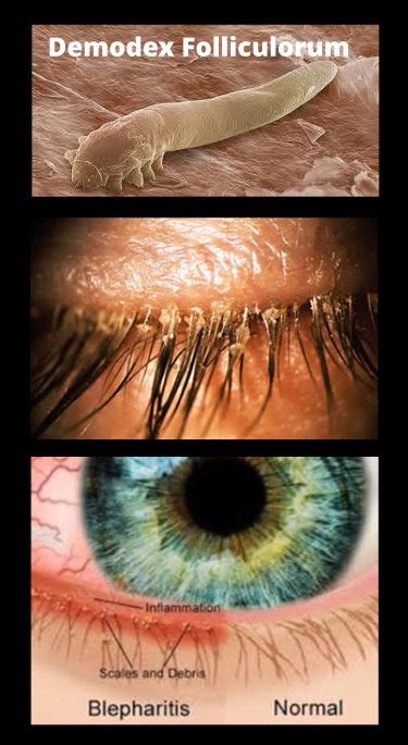 Demodex Blepharitis Eye Care Solutions