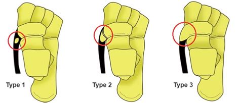 Accessory Navicular Bone Navicular Bone Wikipedia